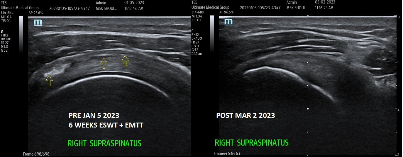Stem Wave Therapy vs Shock Wave Therapy - Prolotherapy | PRP | Stem ...